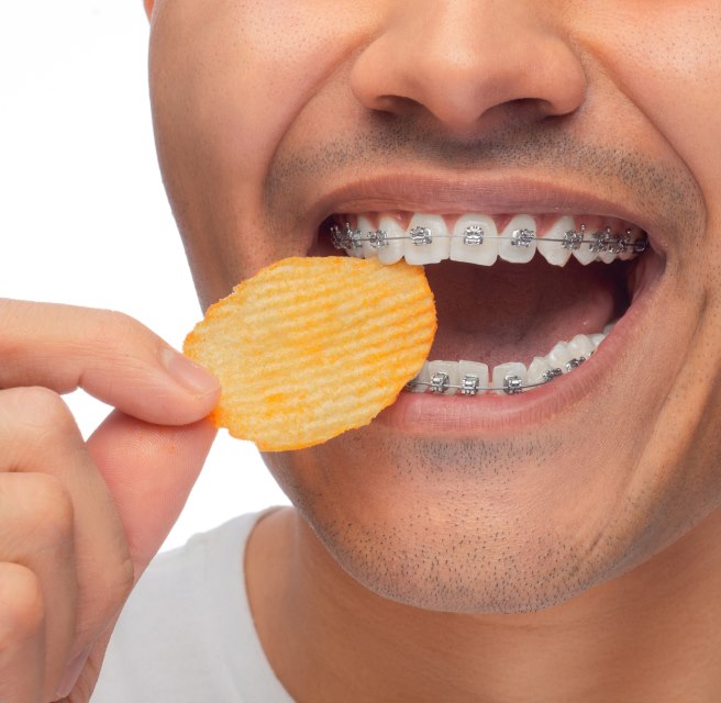 Foods to Avoid with Braces | Eat Smart for a Healthy Smile